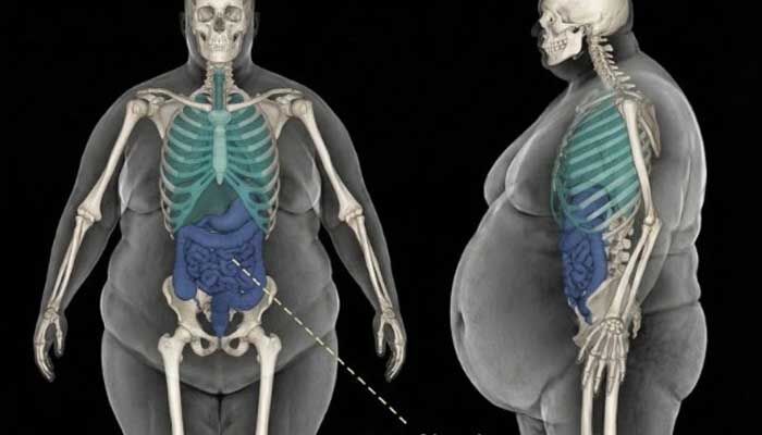 ఒబేసిటీ ఎఫెక్ట్.. పట్టుకోల్పోతున్న ఎముకలు! | Doctors have revealed that ...